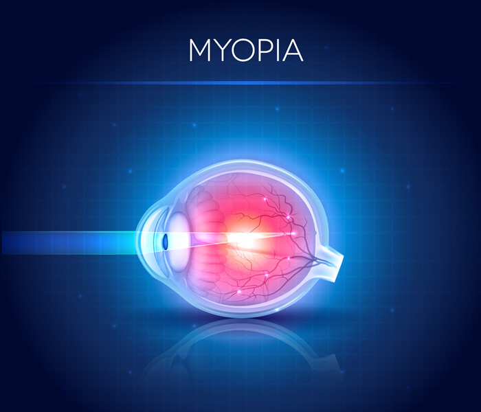 Myopia Control